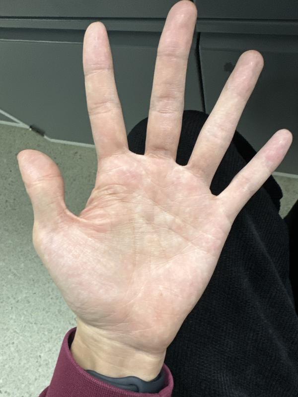 3k3k 的想法: 这是肝掌吗 | 半年前体检肝功彩超都没问题，但是刷到个肝掌的视频，有点子慌 #肝掌