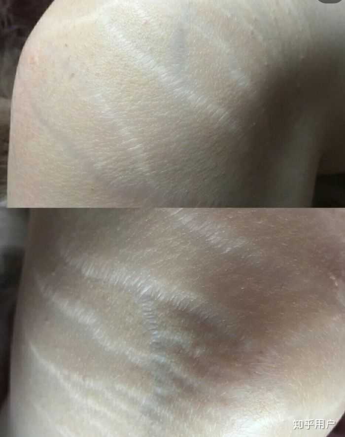 腿上有生长纹怎么解决? 知乎