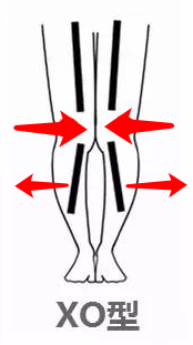 XO型腿如何靠按摩或锻炼矫正？ - 知乎