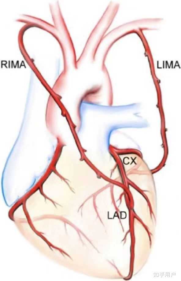 医生说心脏搭桥手术保十到十五年是什么意思？ - 知乎