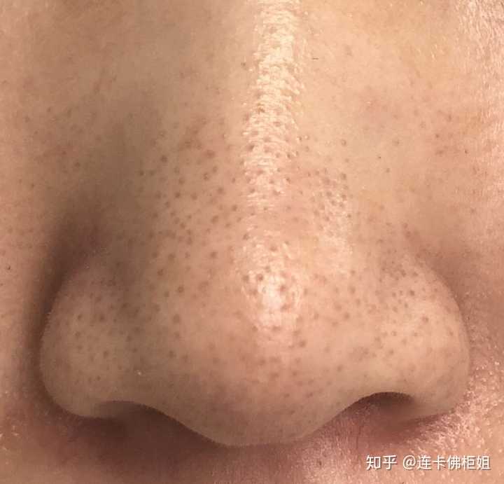 鼻子上长黑毛还挺重的，鼻翼两边都是，怎么办，挺绝望的。？ 知乎