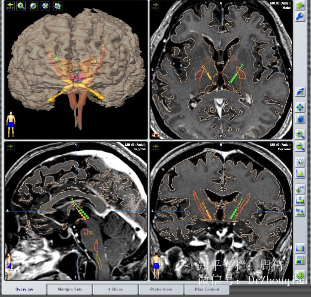 【原创】在美国参加DBS手术丨多图详解DBS脑深部电刺激术治疗帕金森 - 知乎