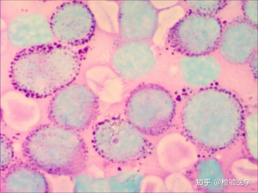 急性单核细胞白血病分型，你真的清楚吗？ - 知乎