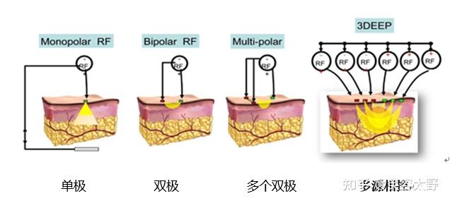 美迪迈EndyMed pro 3Deep 真的能够媲美热玛吉？ - 知乎