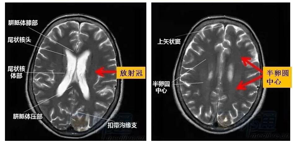 神内临床笔记56 正常颅脑MRI表现 - 知乎