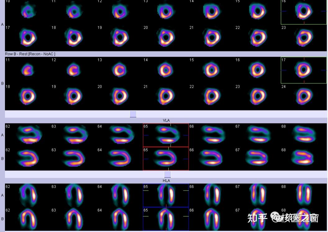 “万能核素”——锝-99m，在核医学中的应用 - 知乎