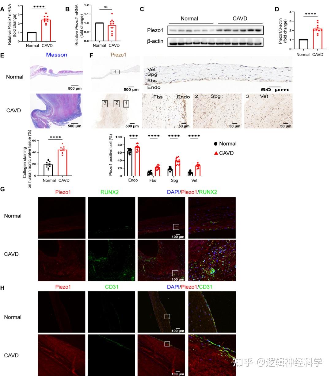 Sci Adv︱南方医科大学曾庆春/许顶立团队揭示Piezo1通过调控谷氨酰胺代谢促进钙化性主动脉瓣疾病发生发展的新机制 - 知乎