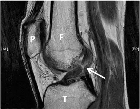 前交叉韧带（ACL）影像解剖、损伤机制、MR诊断、分级以及直接与间接征象 - 知乎