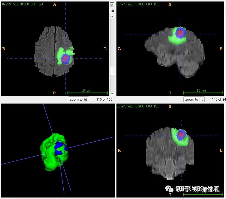 BraTS2023-GLI——BraTS2023成人胶质瘤分割挑战赛 - 知乎