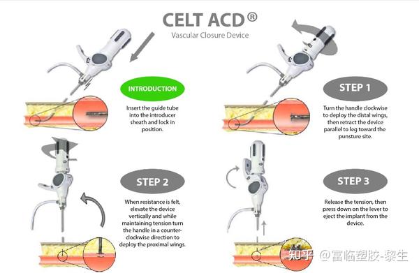 血管闭合：可以分为有源设备和无源设备 - 知乎