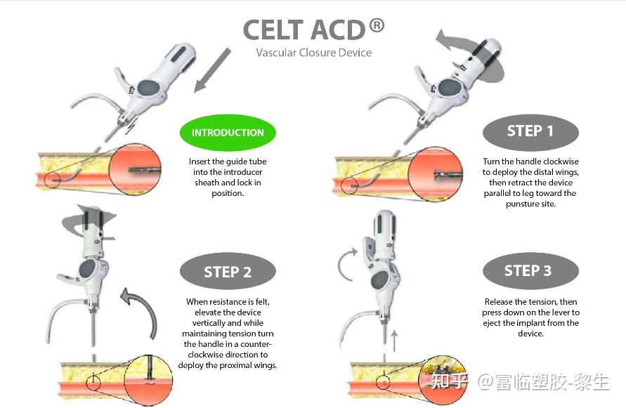 血管闭合：可以分为有源设备和无源设备 - 知乎
