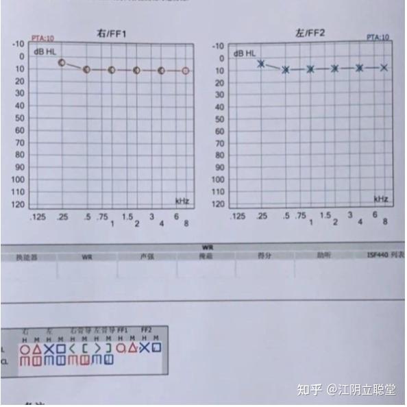 正常的听力水平应该是什么样的呢？ - 知乎