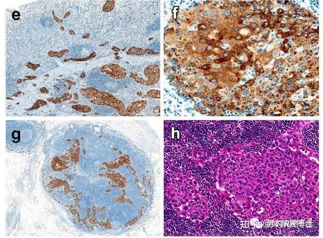 首例ATP1B1-NTRK1融合的胃癌病例 - 知乎