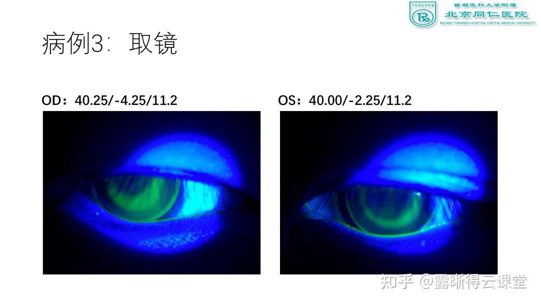 角膜地形图解读及露晰得塑形镜验配要点（文字版） - 知乎