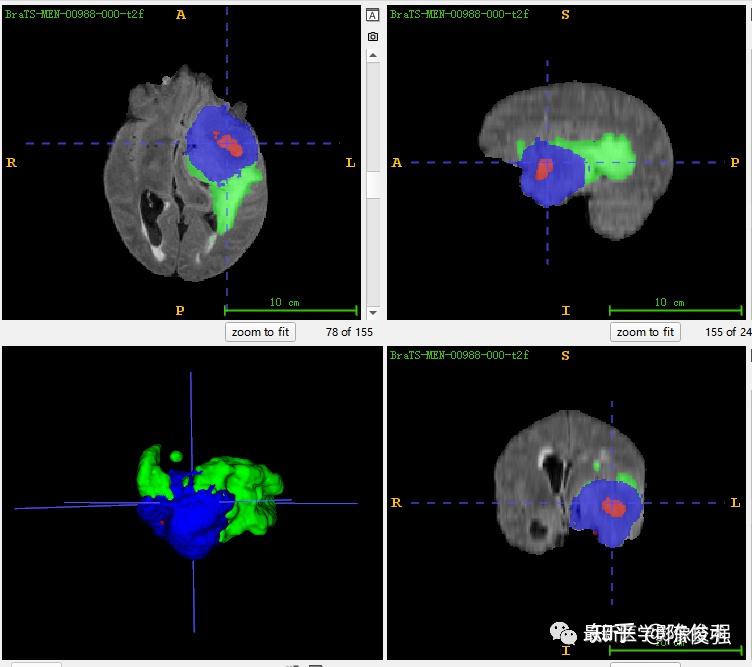 BraTS2023-MEN——BraTS2023颅内脑膜瘤分割挑战赛 - 知乎
