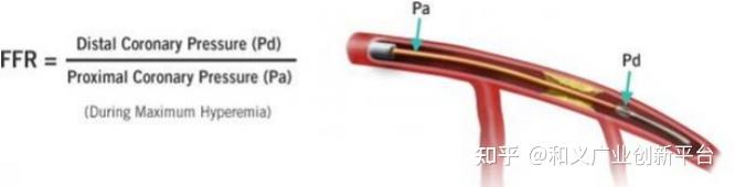 血流储备分数2——一文了解，FFR、FFRct技术原理、特点及应用 - 知乎