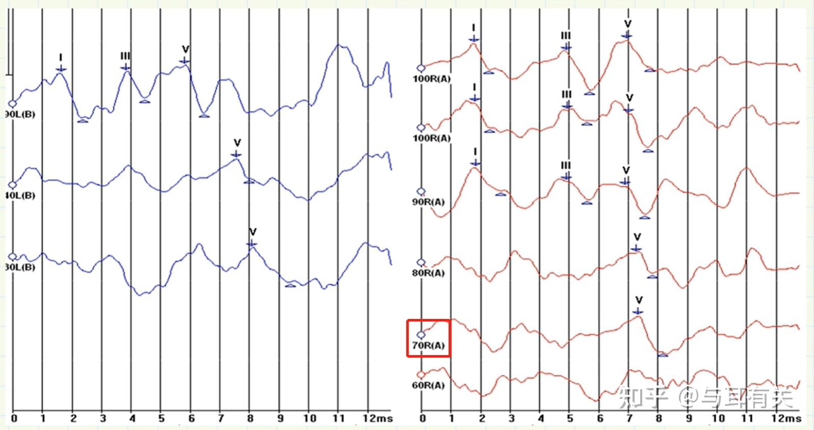 听性脑干反应(ABR) 操作方法、结果解读及临床应用 - 知乎