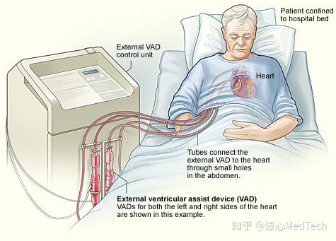 心室辅助装置 (VAD) - 知乎