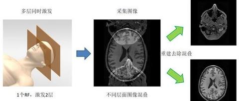 DTI技术原理及临床应用 - 知乎