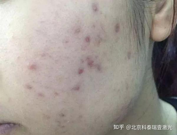 痘坑痘印的炎症表现及产生 知乎