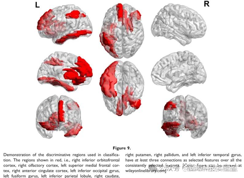 Hum Brain Mapp：基于连接强度加权稀疏群表示的脑网络构建新方法可用于轻度认知障碍分类 - 知乎