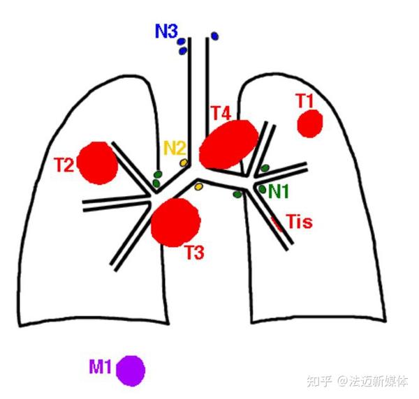 收藏|肿瘤TNM分期法 - 知乎