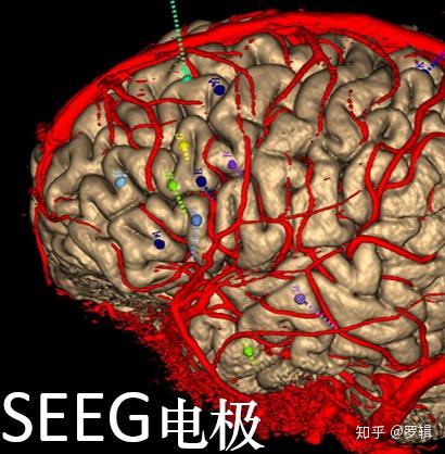 SEEG引导下射频热凝毁损术—难治性癫痫的新希望 - 知乎