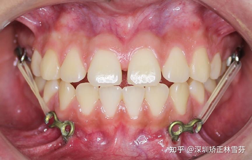 扩弓前牵的一些新思路 - 知乎