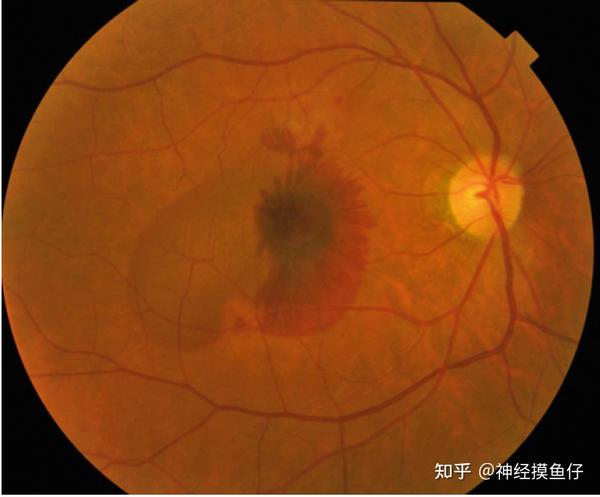 Chen et al. (2019) Retinal OCT Image Analysis 学习笔记 - 知乎