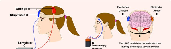 （754）经颅直流电刺激 (tDCS) 无法治疗抑郁症 - 知乎