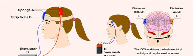 （754）经颅直流电刺激 (tDCS) 无法治疗抑郁症 - 知乎