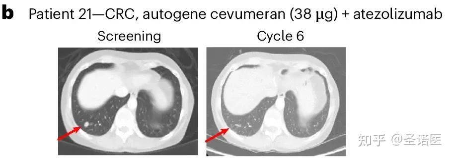 个体化mRNA癌症疫苗BNT122(Autogene Cevumeran、RO7198457)帮患者肿瘤缩小近10倍，多癌种晚期患者获益显著 - 知乎