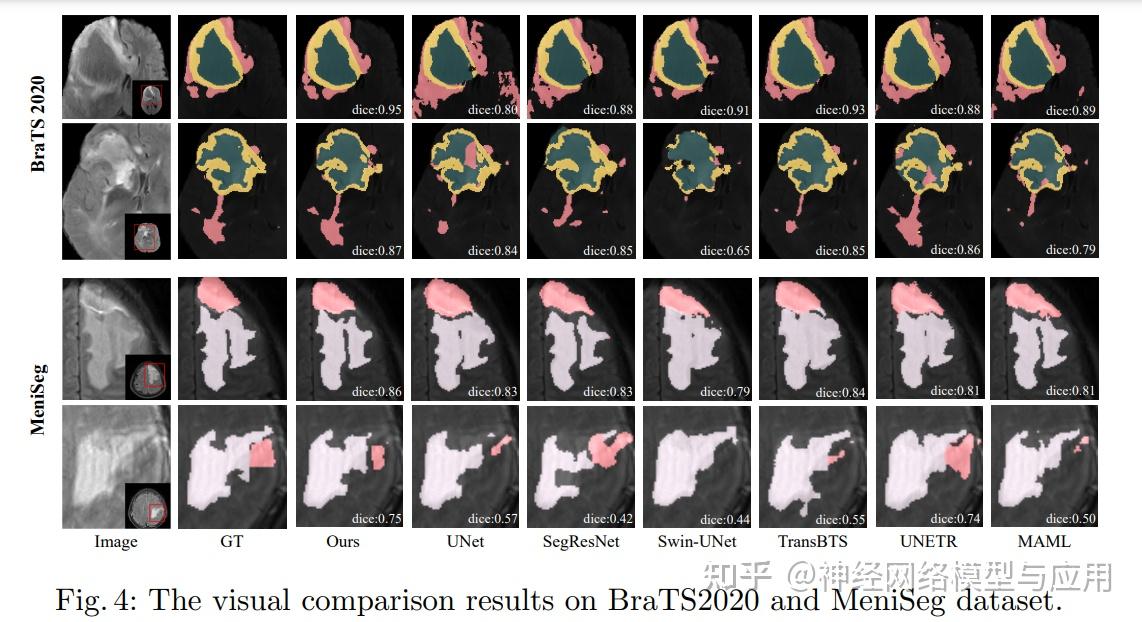 Nestedformer Nested Modality Aware Transformer For Brain Tumor Segmentation论文精读 知乎