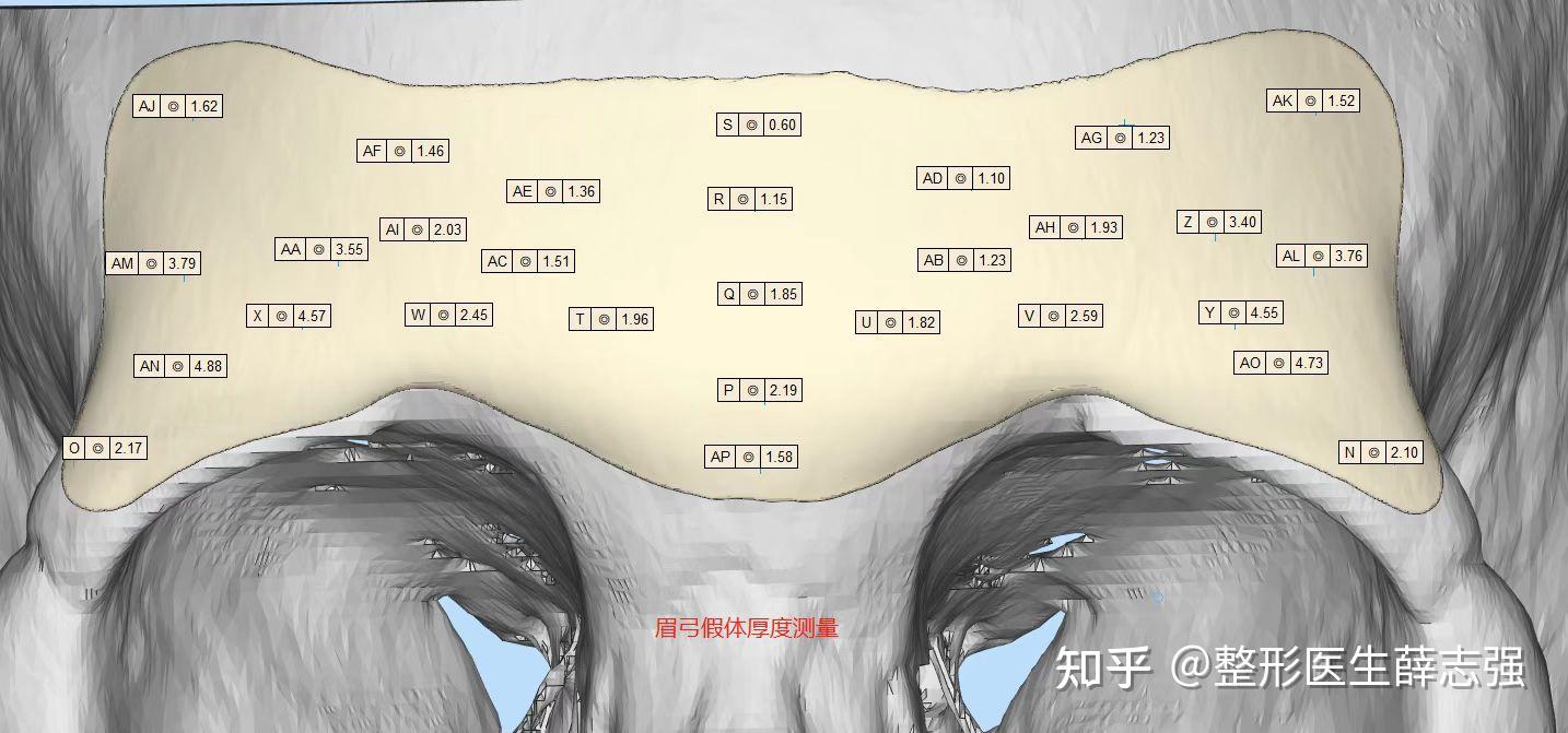 光刻骨案例展示分析 --- 3D打印PEEK填充眉弓 - 知乎