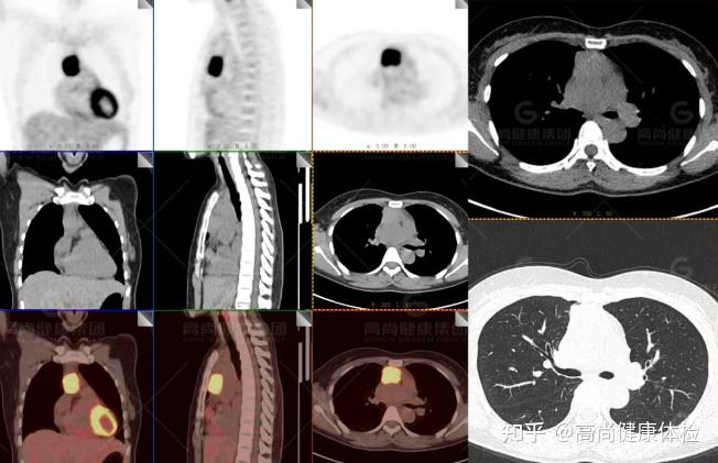 纵隔胸腺瘤PET/CT病例分享 - 知乎
