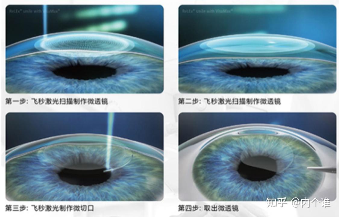 准分子激光角膜屈光治疗仪临床试验设计思路 - 知乎