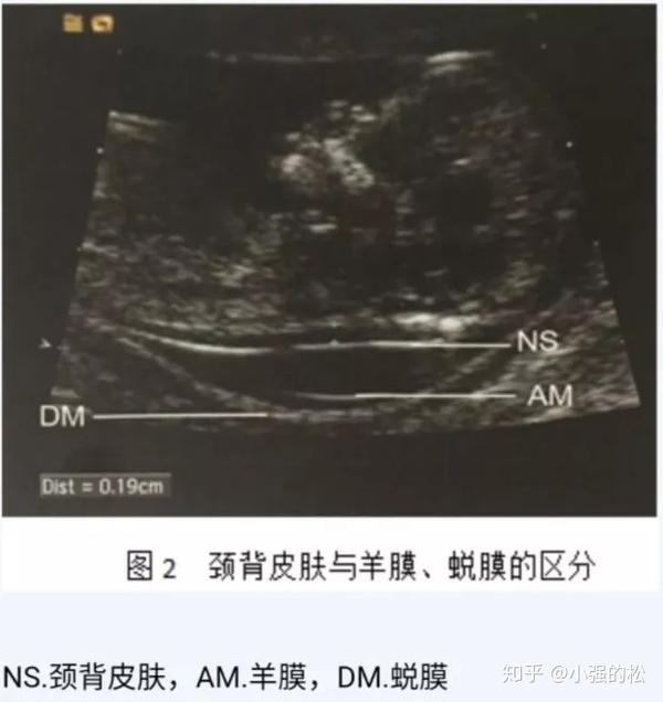 怀孕了，NT结果怎么看？ - 知乎