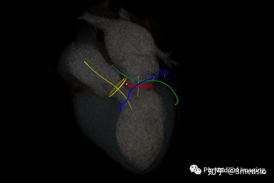 3mensio Mitral - 知乎