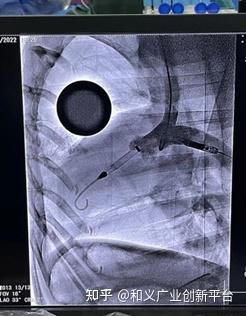 人工心脏5——一文浅析短期PVAD（下） - 知乎