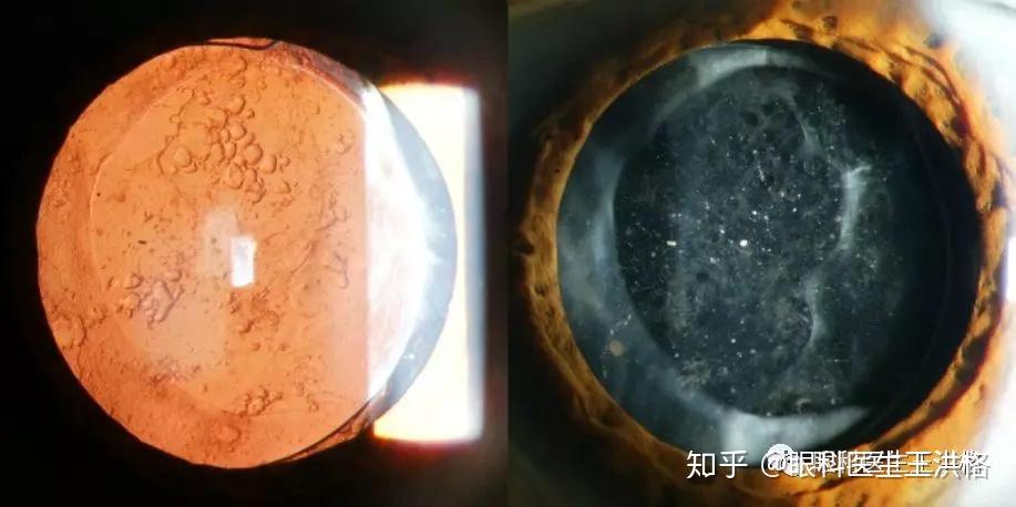 为什么做了白内障手术后又看不见了？ - 知乎
