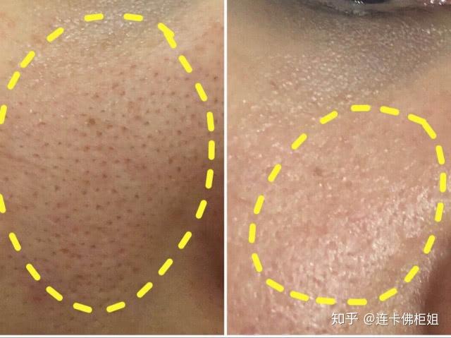 假黑头之三：毛孔粗大形成的黑洞，该如何选用护肤品？ 知乎