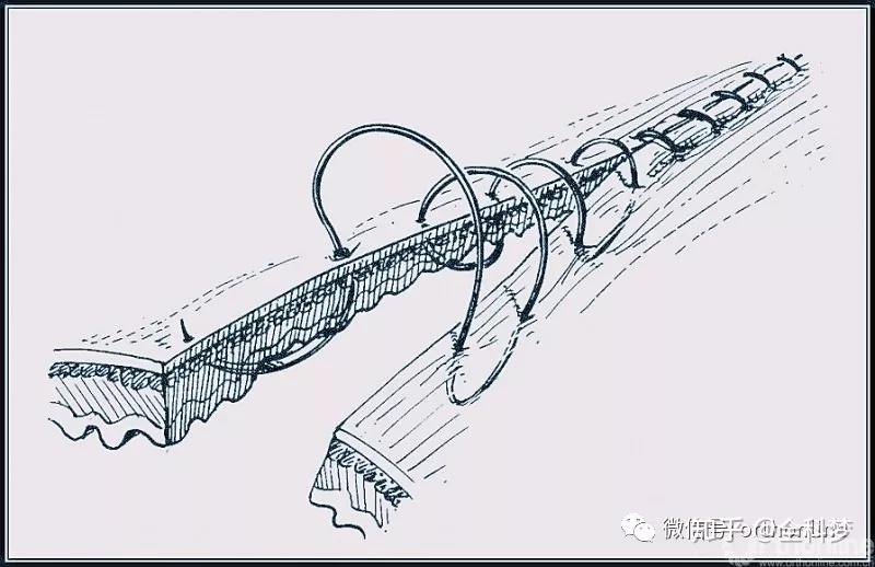 动图，详解常见手术切口缝合技术 - 知乎
