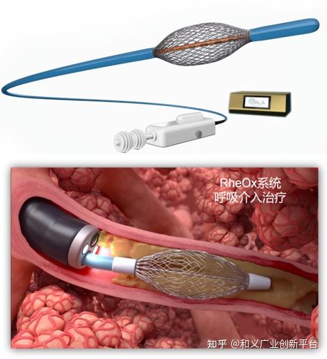 【行研】针对慢性阻塞性肺病的介入治疗器械 - 知乎
