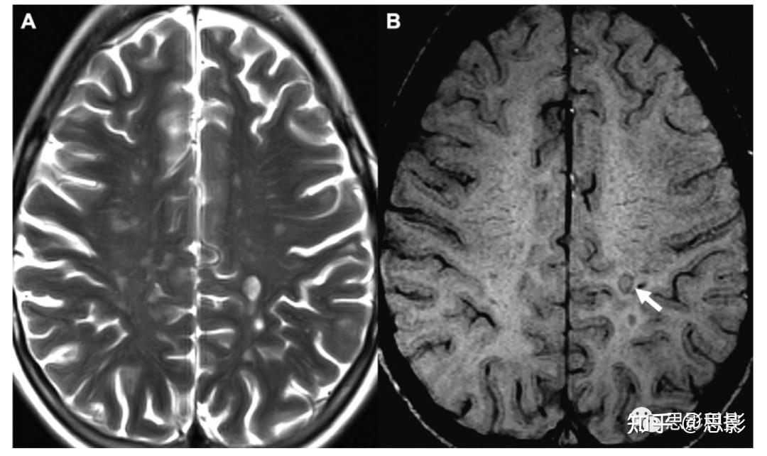 磁敏感加权成像（SWI)：技术要点和临床神经学应用 - 知乎