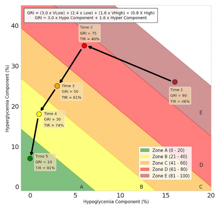 CGM新知｜什么是血糖风险指数（GRI），我们为什么需要它？ - 知乎