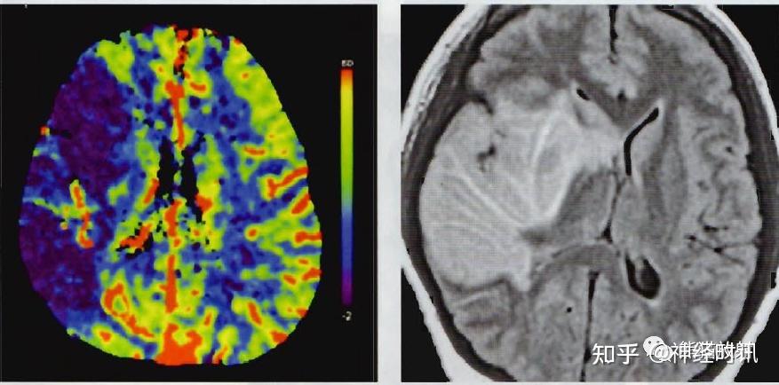 【推荐】大脑前、中、后动脉区梗死总结 - 知乎