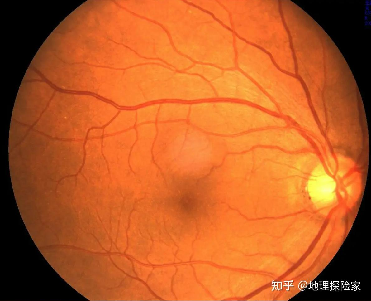 深度学习—各类疾病数据集大合集（附下载地址） - 知乎