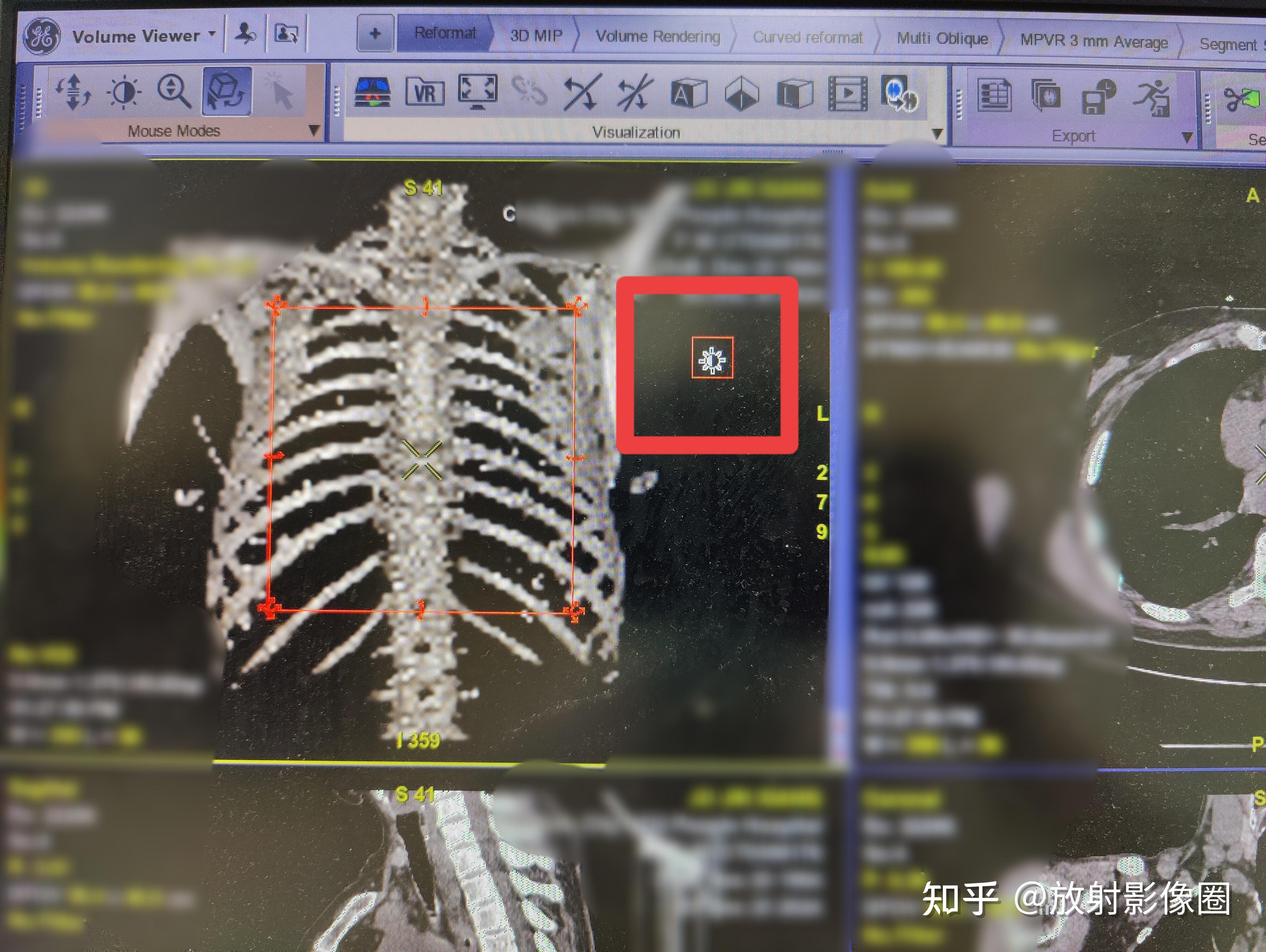 浅谈CT三维重建的操作方法 - 知乎