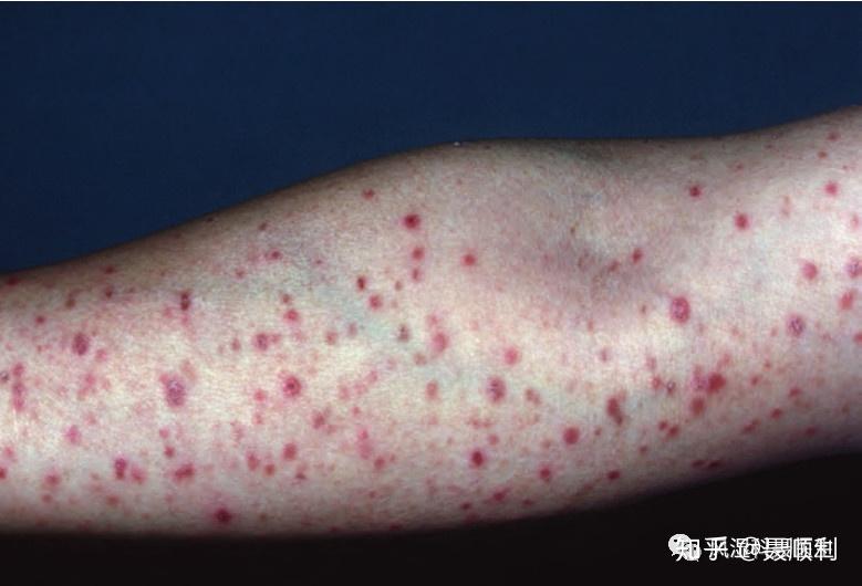 易跟过敏性紫癜混淆的疾病有哪些？（完结篇） - 知乎