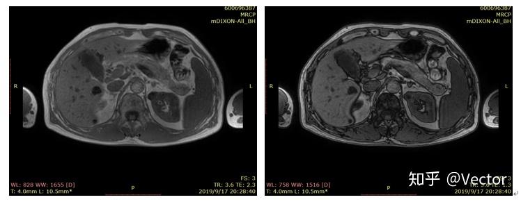 磁共振Dixon技术原理及初代算法解析 - 知乎